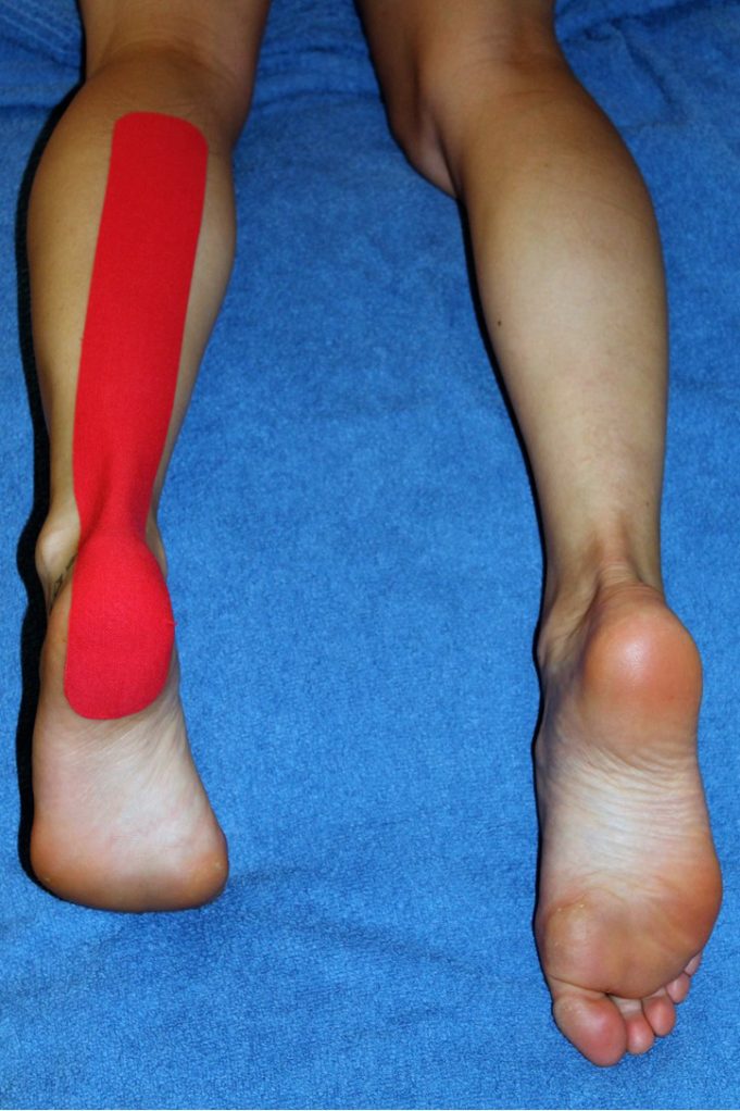 Kinesiology Taping for the Achilles Tendon - UKRunChat